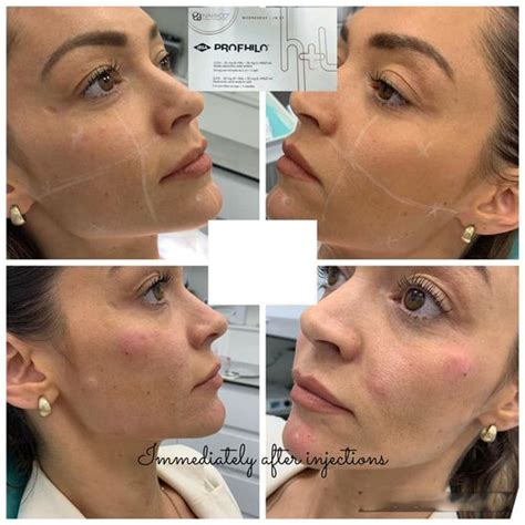 Profhilo Cosmetic Fillers