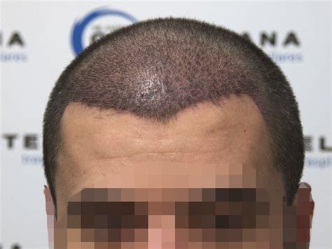 Cómo evoluciona un implante capilar a los 3 meses