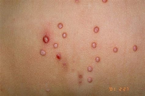 Molluscum Contagiosum Primary Care Dermatology Society Uk