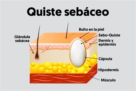 Qué es el Quiste sebáceo y cómo se trata Tua Saúde
