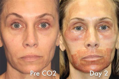 Laser Resurfacing Archives Cosmetic Dermatology Miami FL