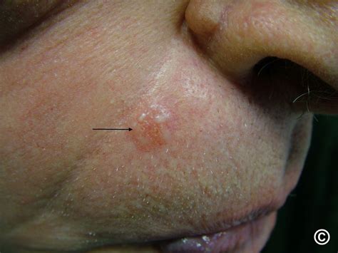 Morphoeic Basal Cell Carcinoma