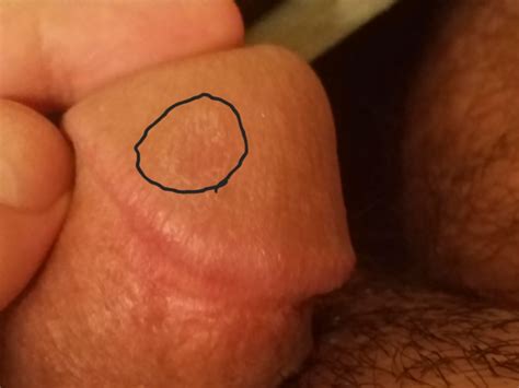 Dry Masturbation Is That Skin Irritation Or Balanitis Or Lichen Planus