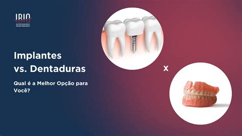 Implantes Dent Rios X Dentaduras Qual A Melhor Op O Para Voc
