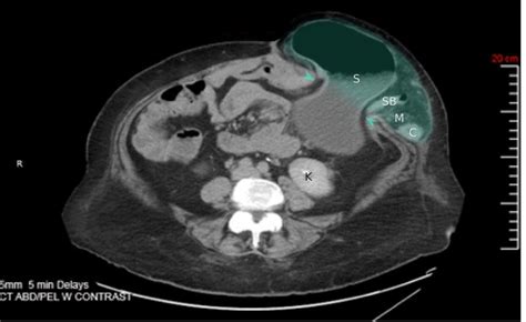 Ventral Hernia Ultrasound