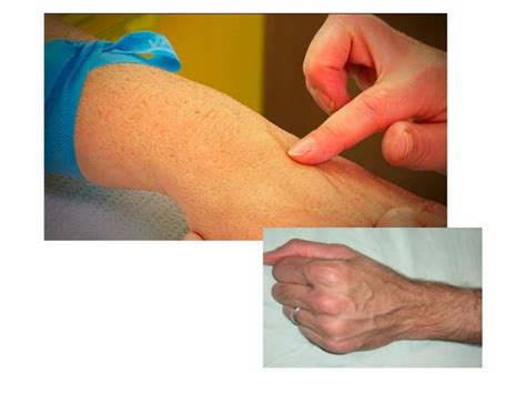 Intravenous Cannulation Ppt