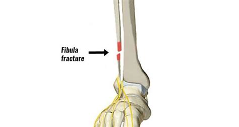 Fibula Fractures Types Symptoms Causes Treatment Zealmax