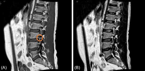 Lumbosacral Spine MRI Radiology Key