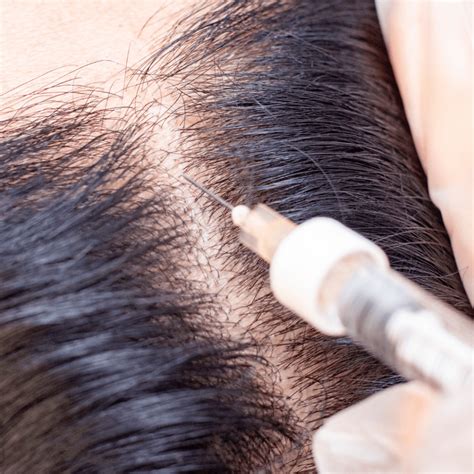 Mesoterapia con Infiltraciones ᐉ Qué es y cómo funciona