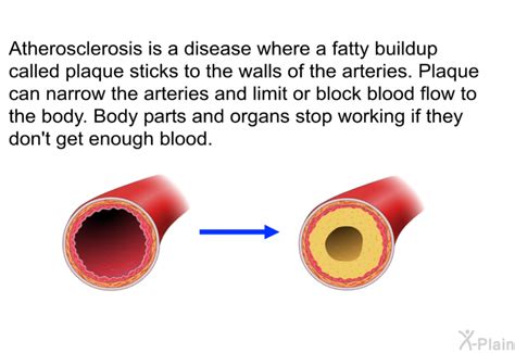 PatEdu Peripheral Artery Disease PAD
