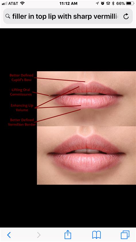 Pin By Tracy Coletti On Beauty Cupids Bow Enhancement Lips
