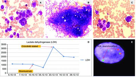 A A Bone Marrow BM Aspirate MayGrunwaldGiemsa Stain Shows