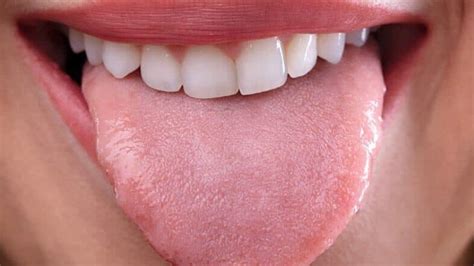 El Color De La Lengua Determina Tu Estado De Salud