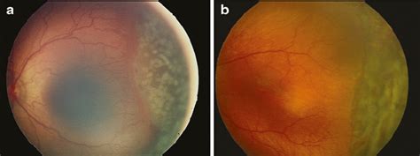 Examples Of Laser Photocoagulation Application In Retinopathy Of