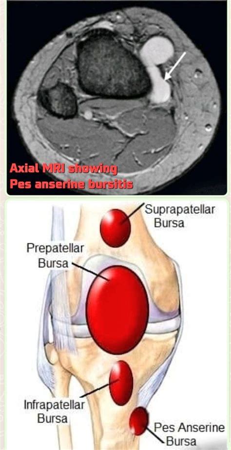 On Twitter Thigh Muscles Pes Anserinus Bursitis