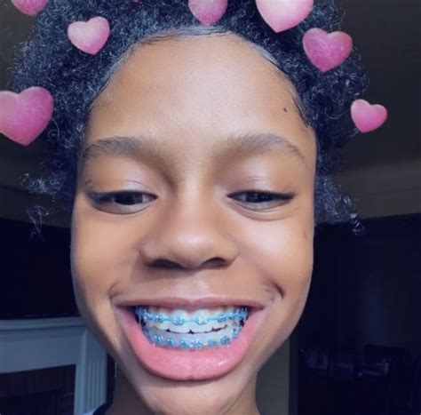 Braces For More Follow Tontaaay The Color Is Aqua Blue Braces