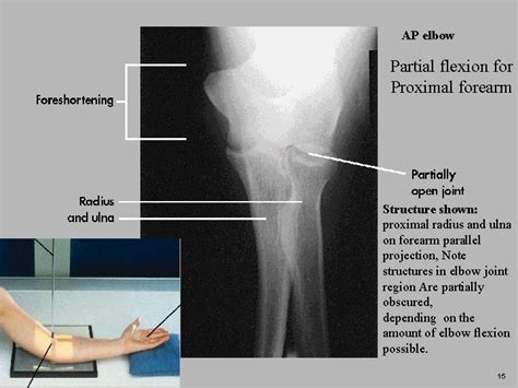 Rad Upper Extremity Part Forearm Elbow