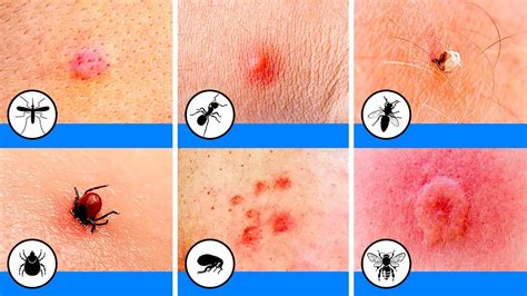 10 Picaduras De Insectos Que Debes Poder Identificar YouTube