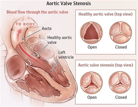 Aortic Stenosis The Heart Vascular Centre