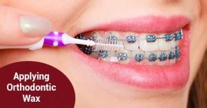 How To Apply Orthodontic Wax David Silberman DDS