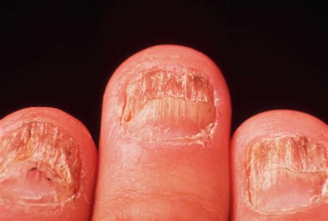 Fungal Infections Pictures