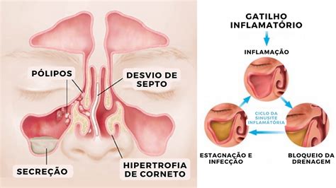 Sinusite crônica Causas sintomas e tratamento Dra Danielly Andrade