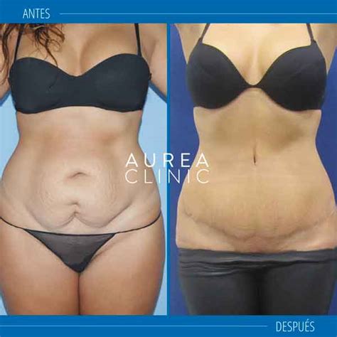 Lista 104 Foto Cuando Puedo Usar Jeans Después De Una Abdominoplastia