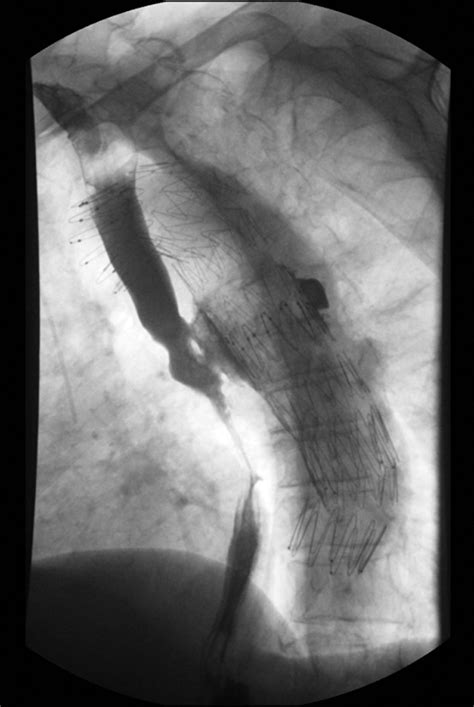 Gastrointestinal Fluoroscopy Radiology Key