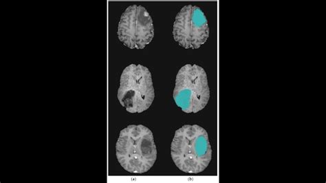 brain tumor segmentation and classification using dense layer neural network matlab 91
