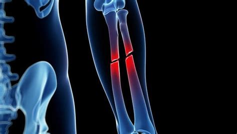 Todo lo que debe saber sobre las fracturas óseas Top Doctors