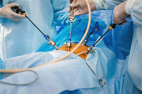 Mini Gastric Bypass Surgery Medworld Obesity Clinic