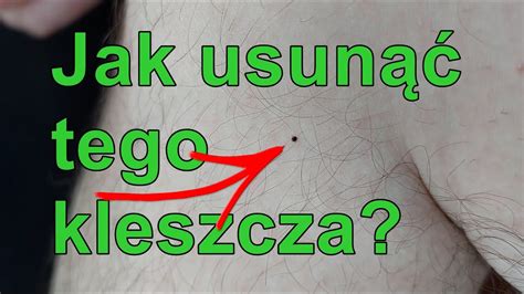 Jak bezpiecznie usunąć kleszcza KLESZCZ wbity w nogę YouTube