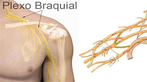 Electromiograf A De Plexo Braquial Neuro Estudios Metepec
