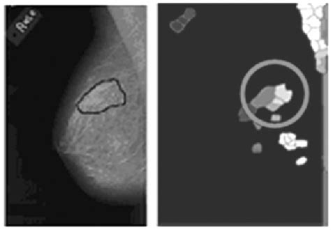 mammogram image segmentation using watershed semantic scholar