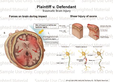 Mechanism Of Diffuse Axonal Injury Motionlit