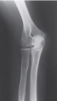 External Oblique Elbow Diagram Quizlet