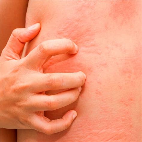 Definition Of Chronic Or Acute Urticaria Causes And Treatment Scope Heal