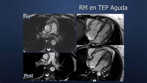Tromboembolia Pulmonar Manejo Guias Europeas PPT