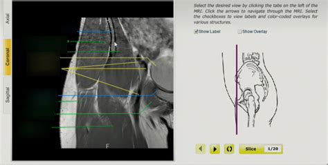 Hip Mri Frontal Plane Slice Diagram Quizlet
