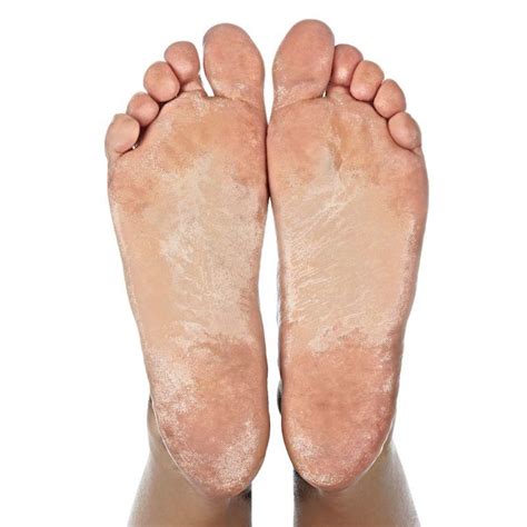 5 Trucos para eliminar los hongos de los pies Mujer de 10 Guía real