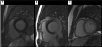 Frontiers Cardiac Magnetic Resonance Imaging In Patients With Left