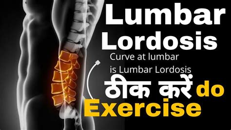 What Is The Fastest Way To Fix Lumbar Lordosis Loss Of Lumbar Lordosis