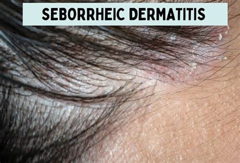 Seborrheic Dermatitis Symptoms Causes And Treatments