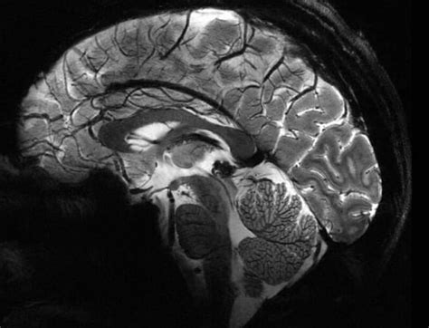 Worlds Most Powerful Mri Machine Captures First Stunning Brain Scans