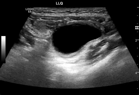 Midgut Volvulus Image Enteric Duplication Cyst Ultrasound In