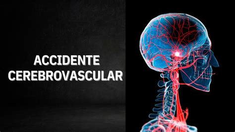 Acv Accidente Cerebrovascular Maryuri Lisbeth Udocz