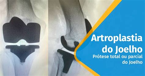 Artroplatia Do Joelho Cirurgia De Pr Tese Do Joelho Dr Alexandre