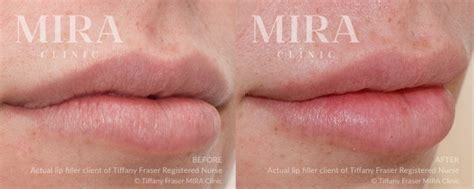 Lip Fillers Perth Lip Injections Enhancement MIRA Clinic