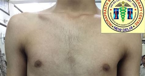 Indraprasth Physiotherapy Centre Pigeon Chest Pectus Carinatum