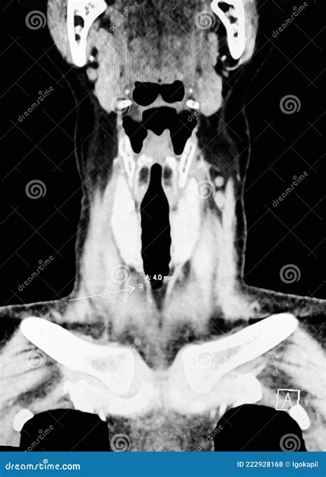 4d Ct Scan Of Parathyroid Adenoma Modern Exam Stock Photo Image Of